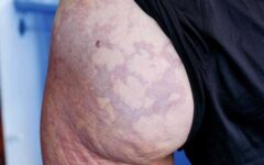 Skin Bends: A Guide to Cutaneous Decompression Sickness